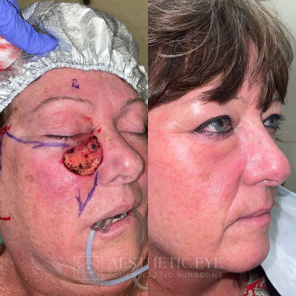 Cincinnati OH Eye Lid Reconstruction After Eyelid Skin Cancer (MOHS) Surgery | Dayton