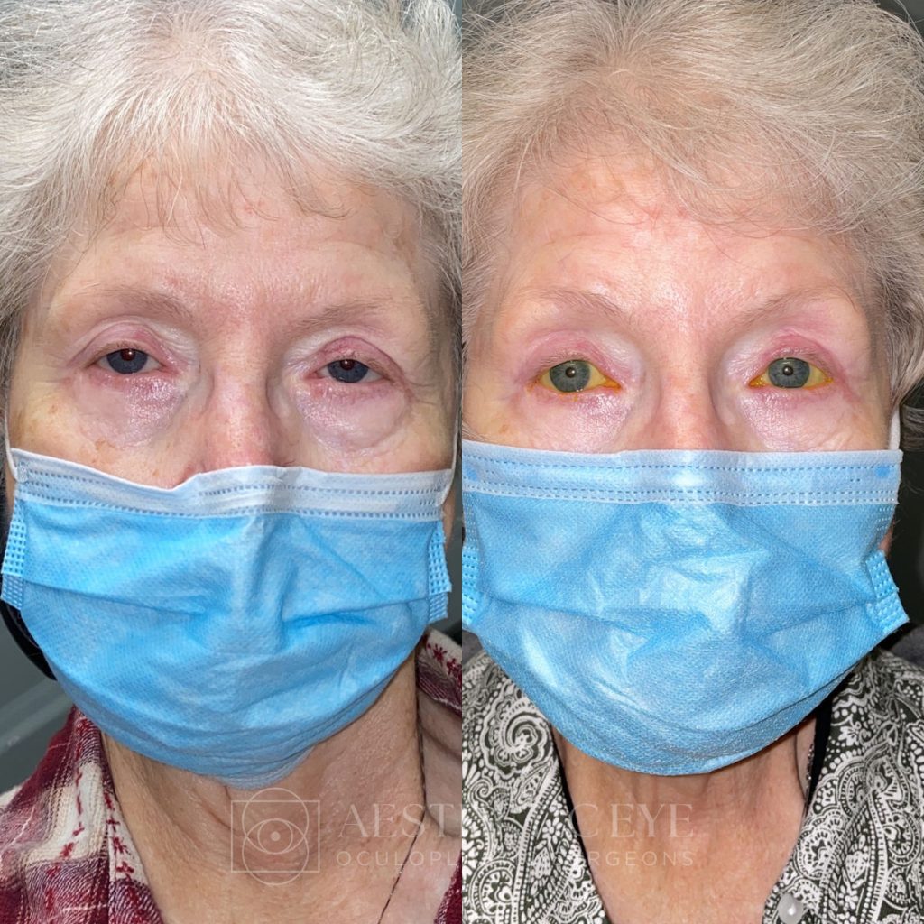 Lower Eyelid Blepharoplasty Archives | AestheticEye